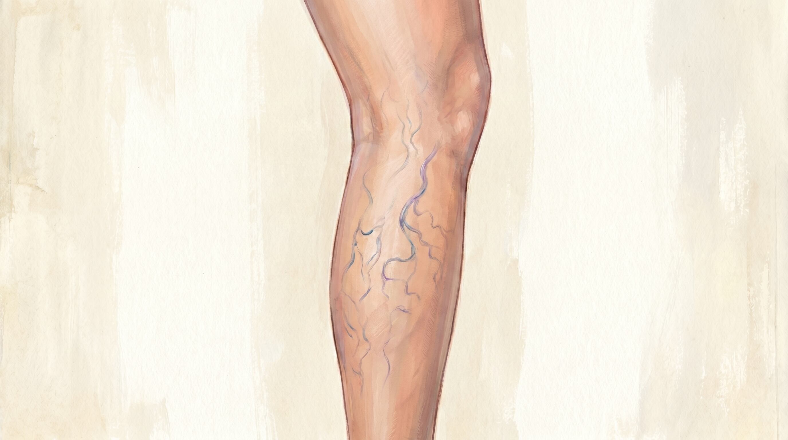 Varices: qué son, cómo surgen y cuándo pueden indicar una afección ...